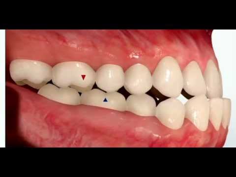 Common Bite Problems - Dupont Orthodontics: Dr. Allison S. Bergdoll ...